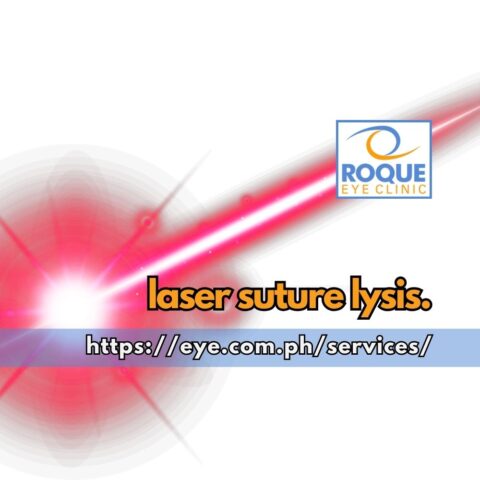 Laser Suture Lysis | One Eye - ROQUE Eye Clinic | Eye.com.ph