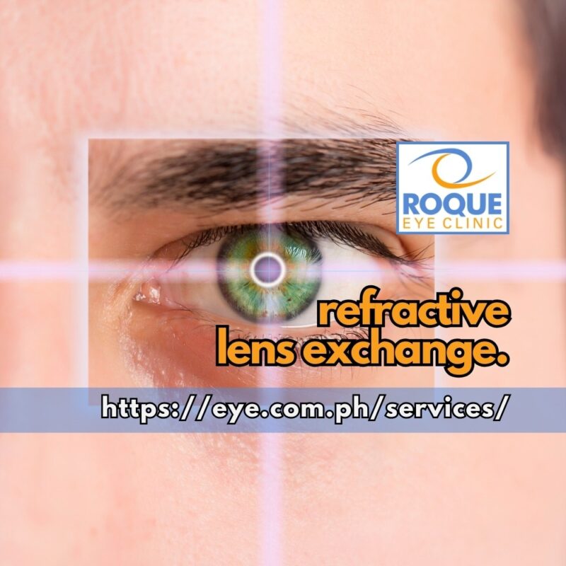 Refractive Lens Exchange (RLE) | One Eye (PF only) - ROQUE Eye Clinic ...