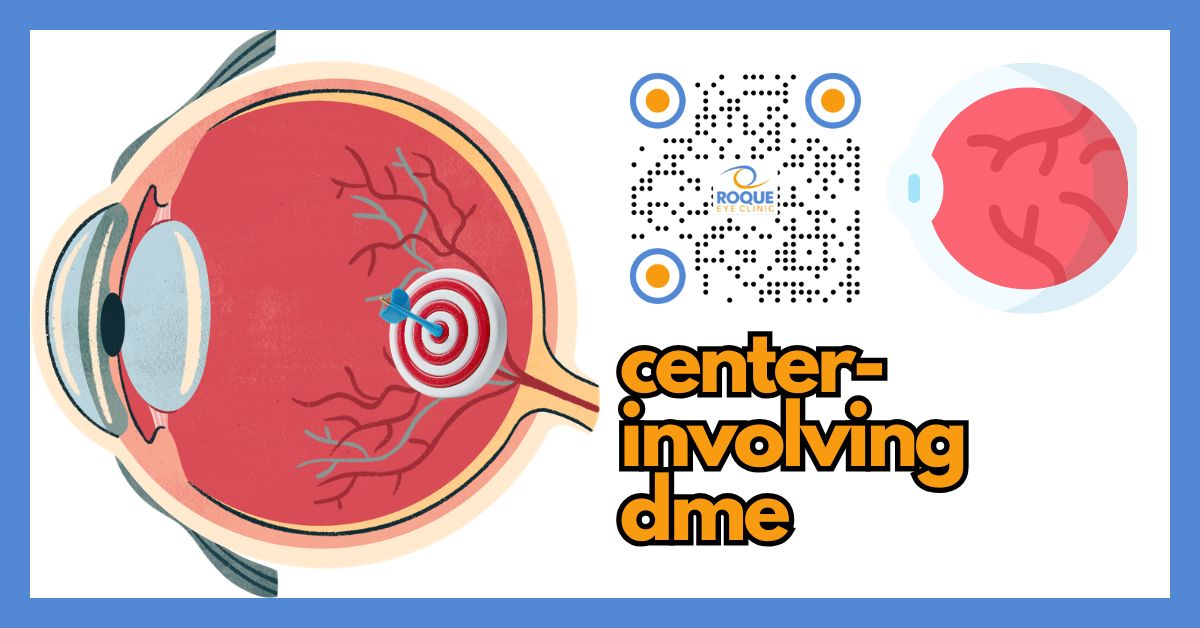 Center-Involving DME: Symptoms, OCT Diagnosis, and Treatment