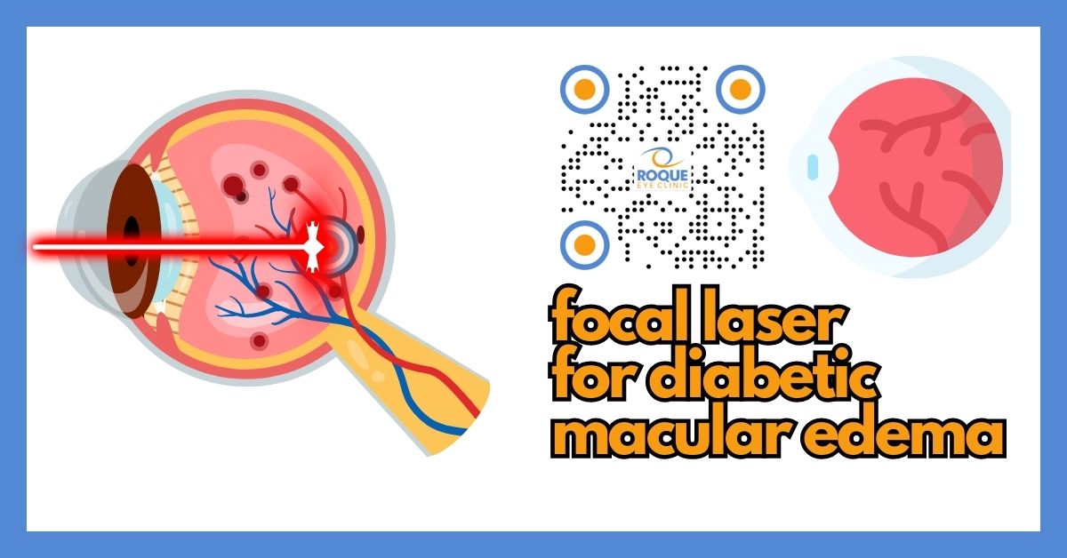 Focal Laser for Diabetic Macular Edema: When It Helps and What to Expect
