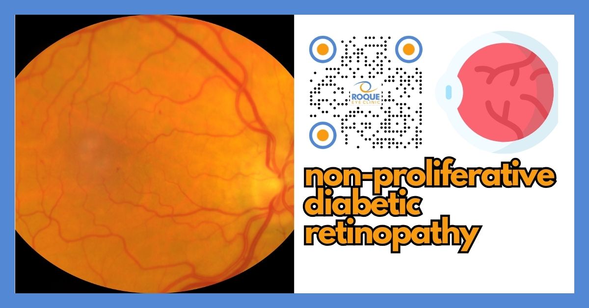 Non-Proliferative Diabetic Retinopathy (NPDR): Early Retinal Damage in ...